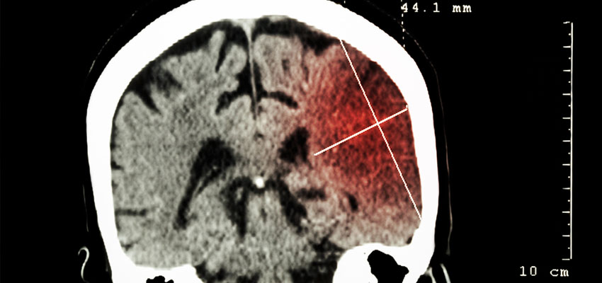 Neural Mechanisms Of Spontaneous Recovery - Stroke Care Neural Mechanisms Of Spontaneous Recovery - Stroke Care